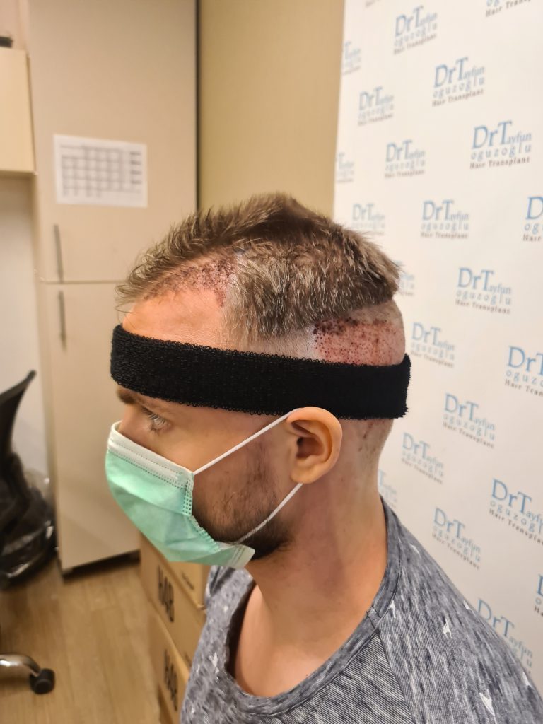 DHI - DrT Hair Best Hair Transplant